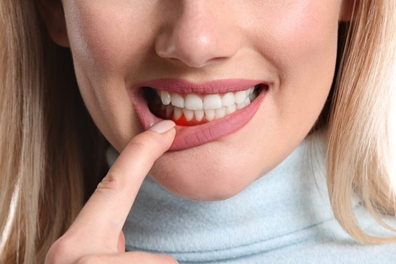 SWOLLEN GUMS TREATMENT - Precision Dental Hub